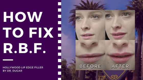 Fix Resting B*tch Face with Hollywood Lip Edge Fillers | Scarless Med ...