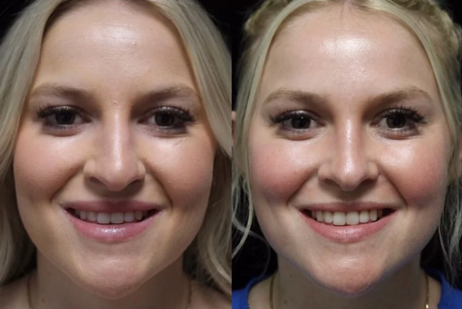 Alcohol: Is 1 month enough? Honest Assessment How Long After a ...