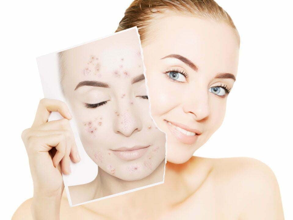 How Celluma Helps With Acne - St. Louis Skin Solutions™