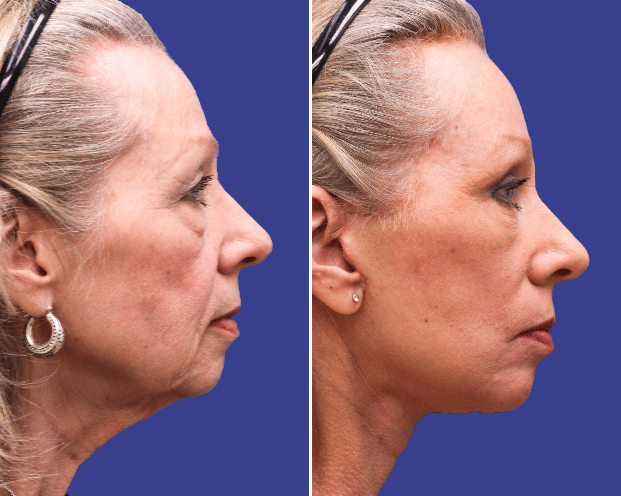 Patient 856785 | Temple Lift Before & After Photos | Dr. Fechner