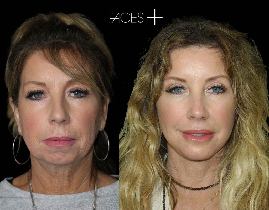Your Comprehensive Guide to Facelift Surgery. | Faces Plus