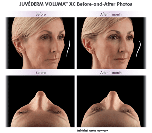 Volumizing Cheeks with Juvederm™ Voluma XC - W Cosmetic Surgery®