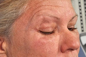 Overfilling the Eyes and How we Fix it - W Cosmetic Surgery®