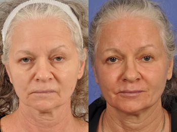 Laser Skin Rejuvenation - W Cosmetic Surgery®