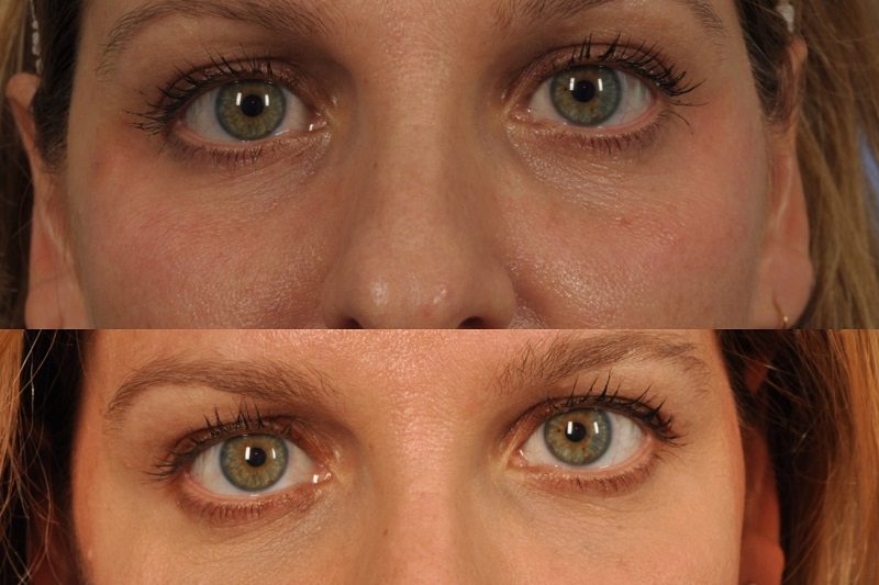 No Downtime Procedures to Improve your Zoom Look - W Cosmetic Surgery