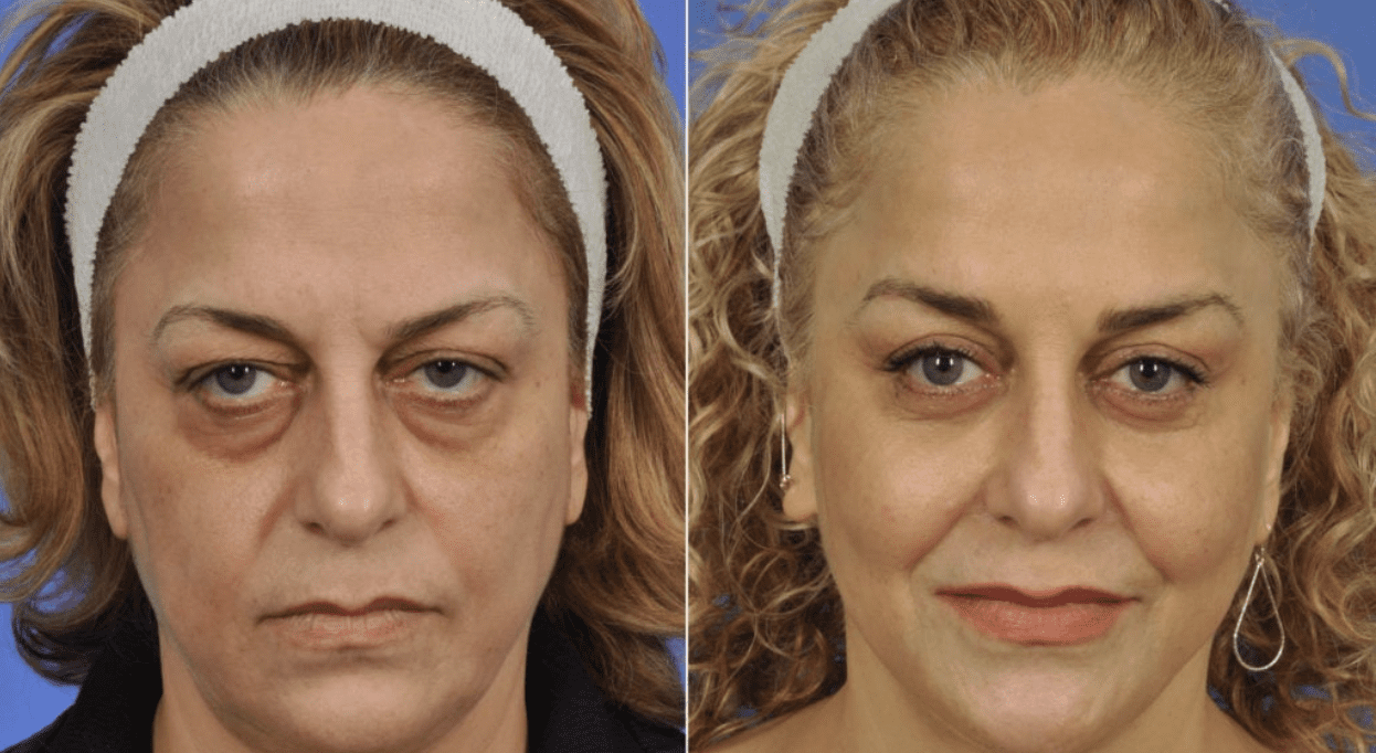 What Are Festoons & How Can They Be Treated?