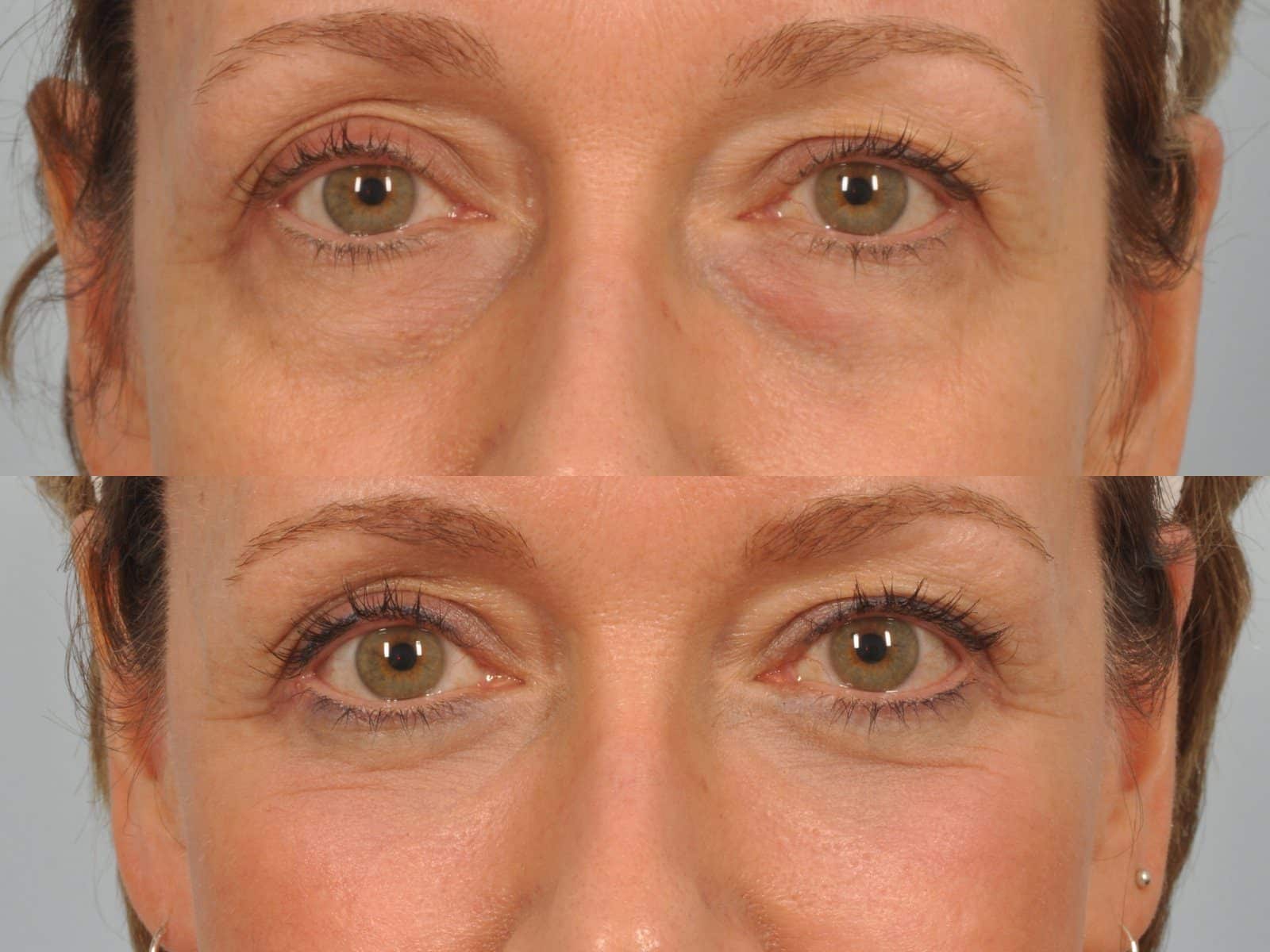Blepharoplasty Before & After Photos | Page 7 | W Cosmetic Surgery