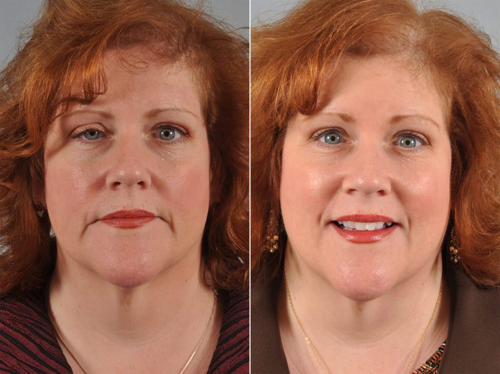 Droopy Eyelids – Ptosis Before & After Photos | W Cosmetic Surgery