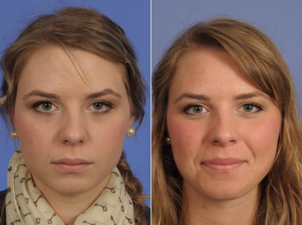 Droopy Eyelids – Ptosis Before & After Photos | W Cosmetic Surgery