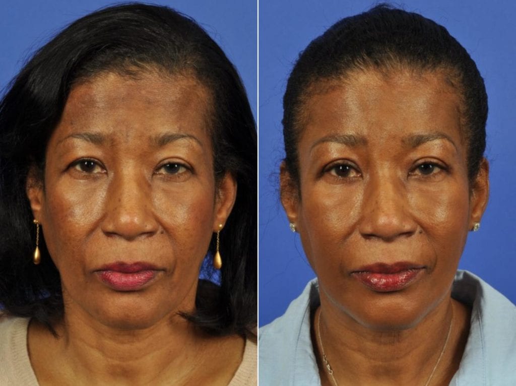 Droopy Eyelids – Ptosis Before & After Photos | W Cosmetic Surgery