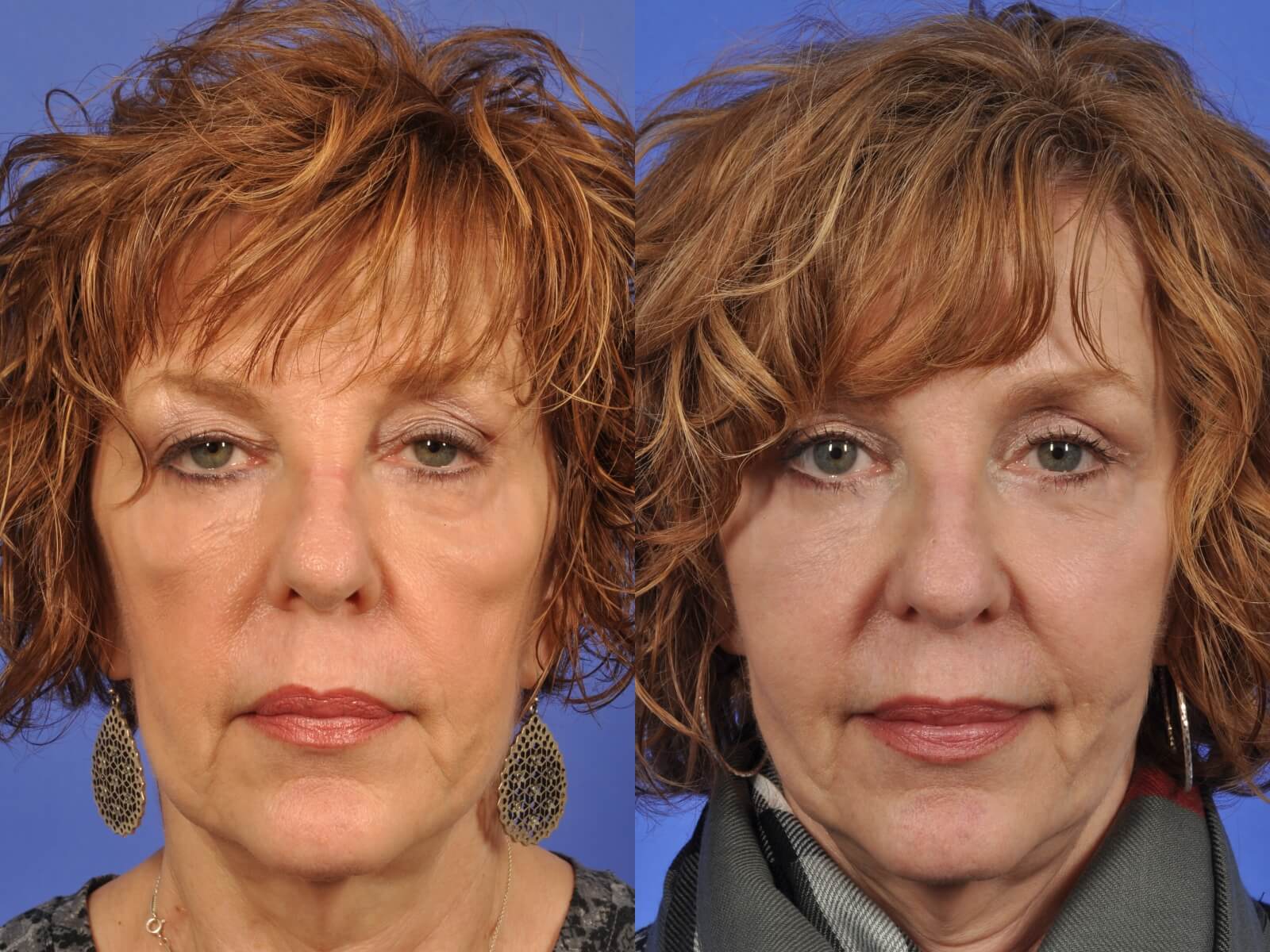 Festoon Surgery Before & After Photos | W Cosmetic Surgery