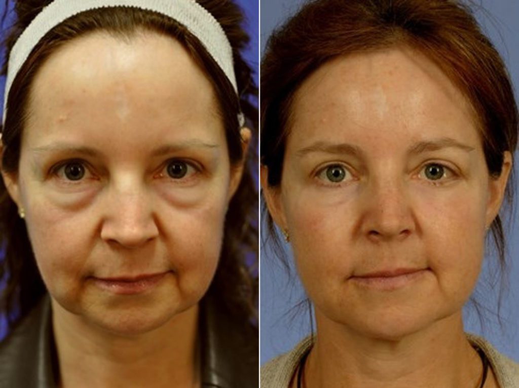 Festoon Surgery Before & After Photos | W Cosmetic Surgery