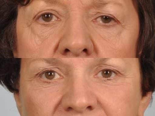 Festoon Surgery Before & After Photos | W Cosmetic Surgery