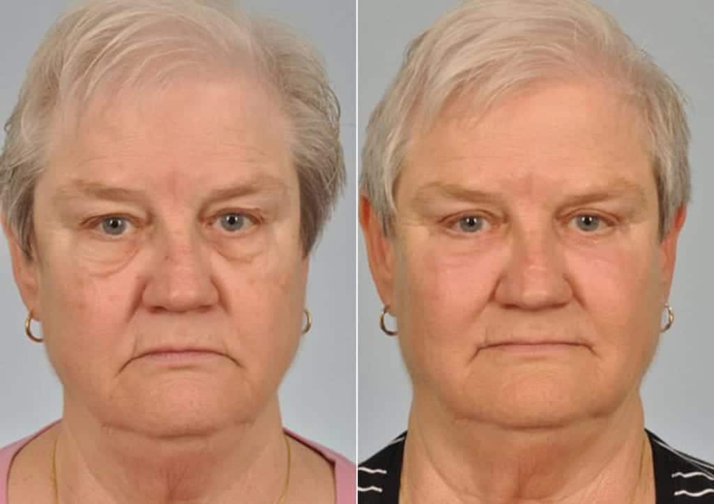 Festoon Surgery Before & After Photos | W Cosmetic Surgery