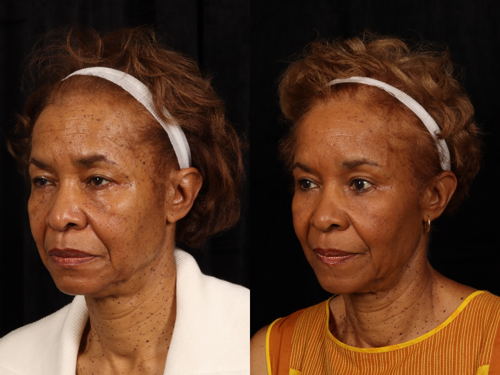 Festoon Surgery Before & After Photos | W Cosmetic Surgery