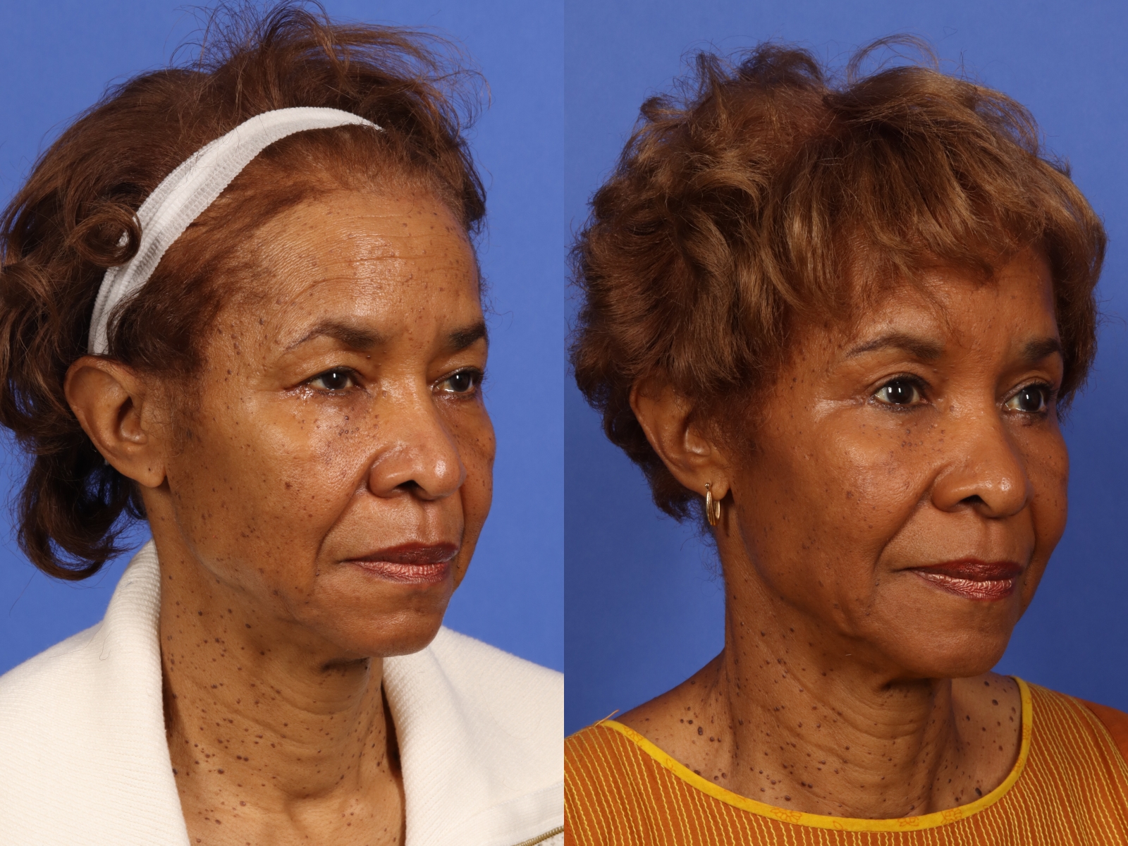 Festoon Surgery Before & After Photos | W Cosmetic Surgery