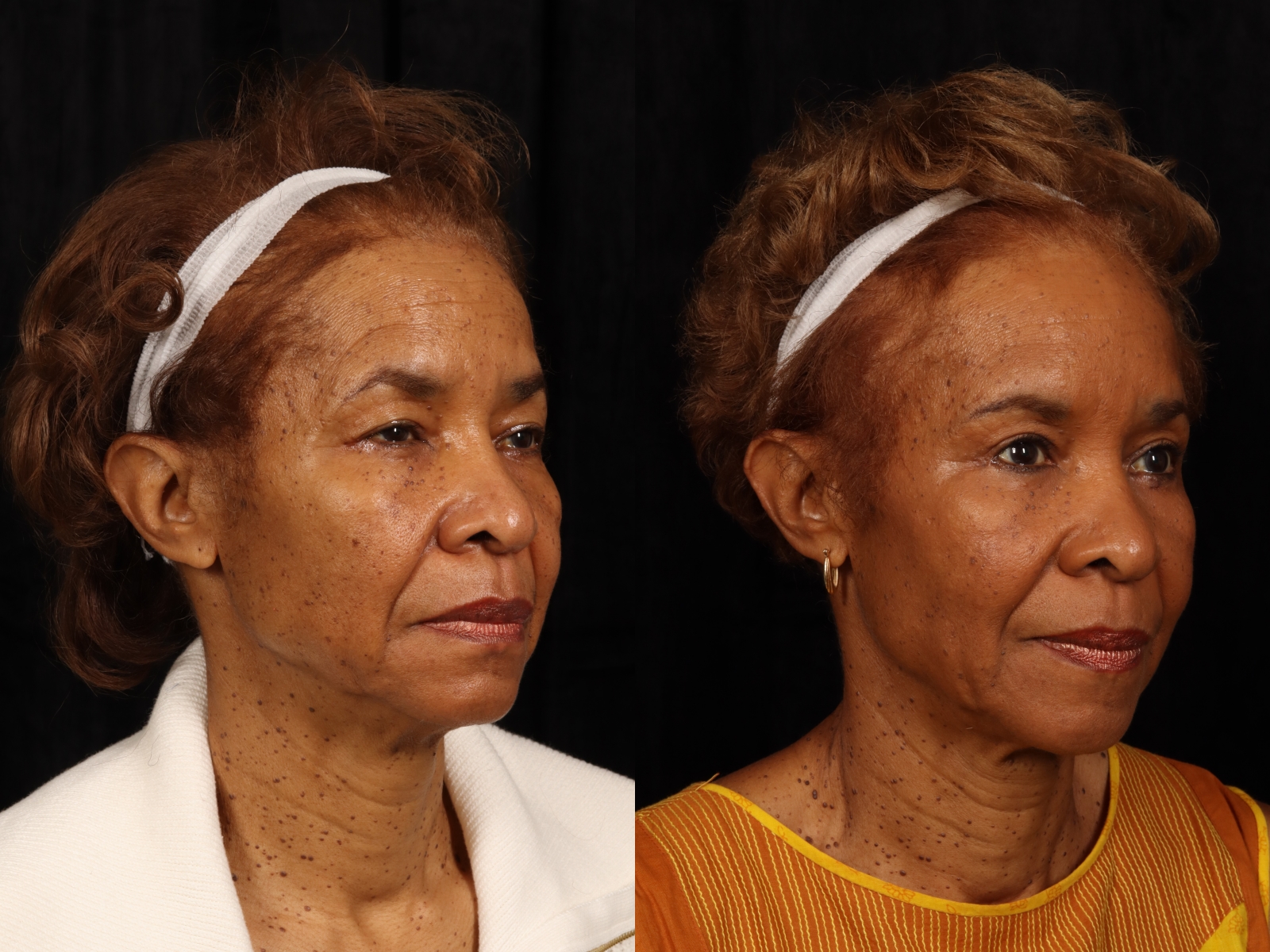 Festoon Surgery Before & After Photos | W Cosmetic Surgery