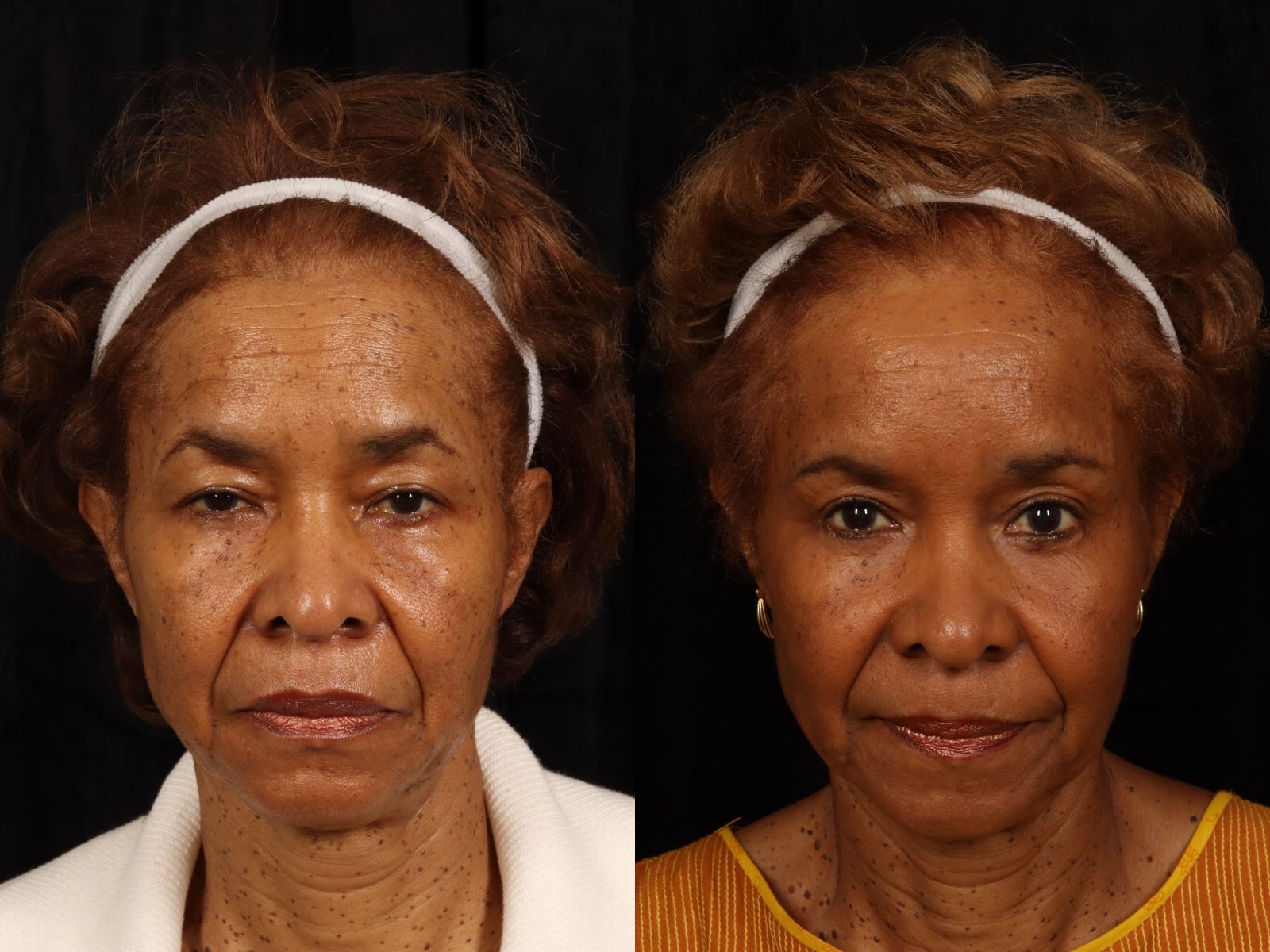 Festoon Surgery Before & After Photos | W Cosmetic Surgery