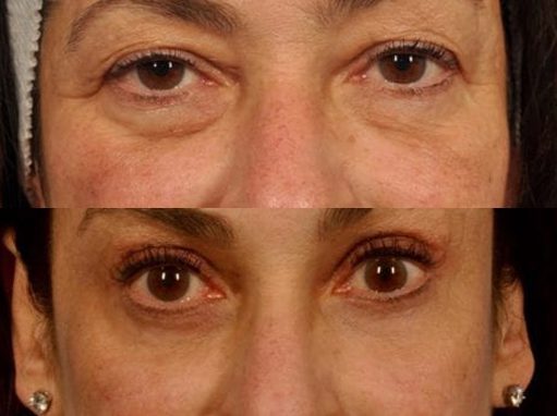 Festoon Surgery Before & After Photos | W Cosmetic Surgery