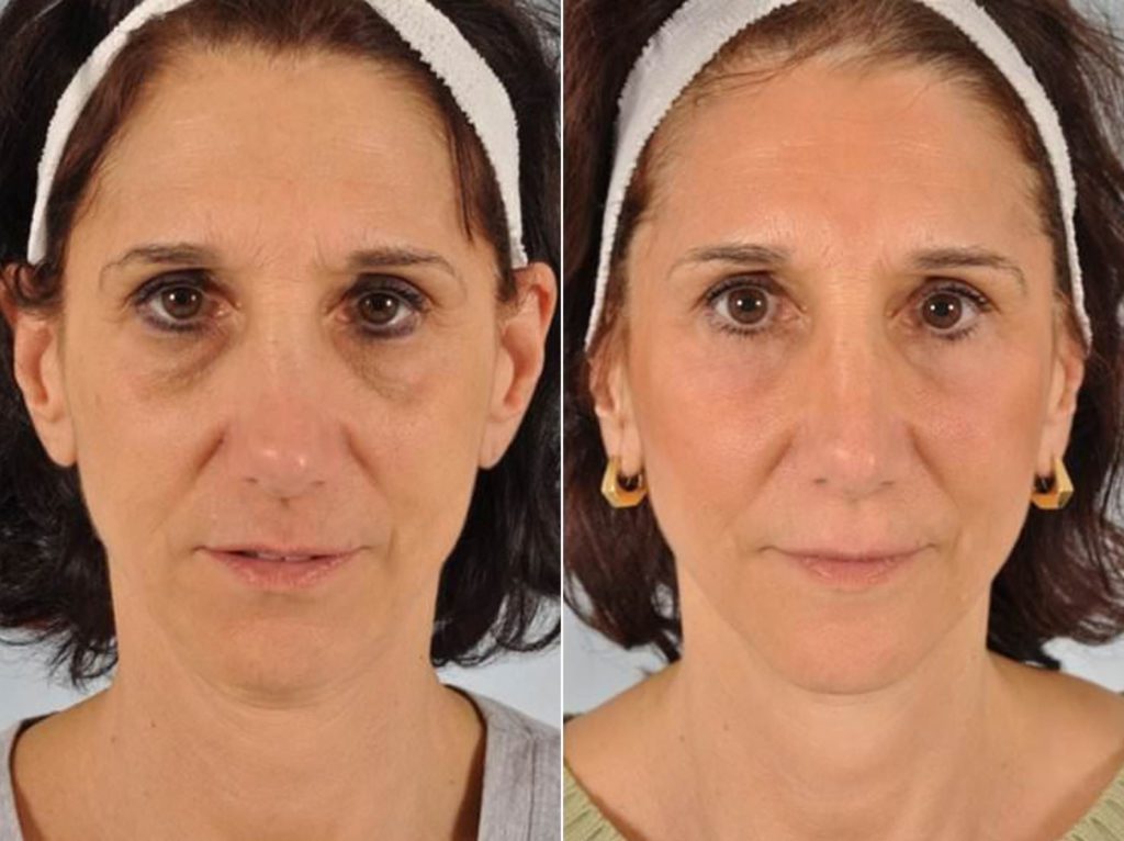 Festoon Surgery Before & After Photos | W Cosmetic Surgery