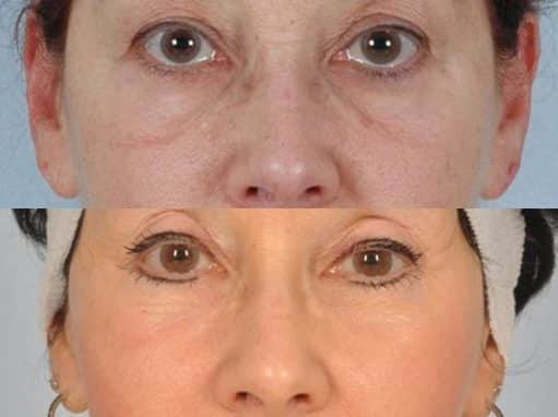 Festoon Surgery Before & After Photos | W Cosmetic Surgery