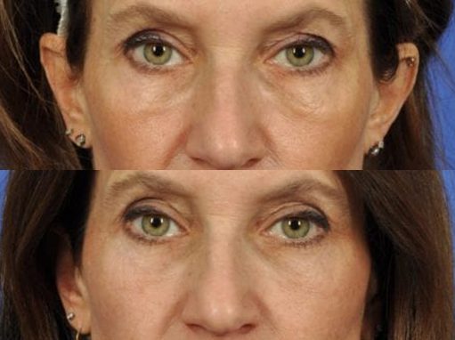 Festoon Surgery Before & After Photos | W Cosmetic Surgery