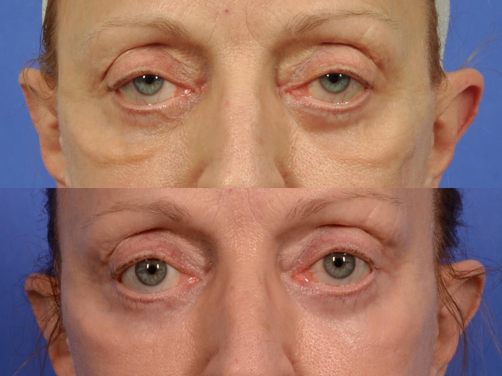 Festoon Surgery Before & After Photos | W Cosmetic Surgery