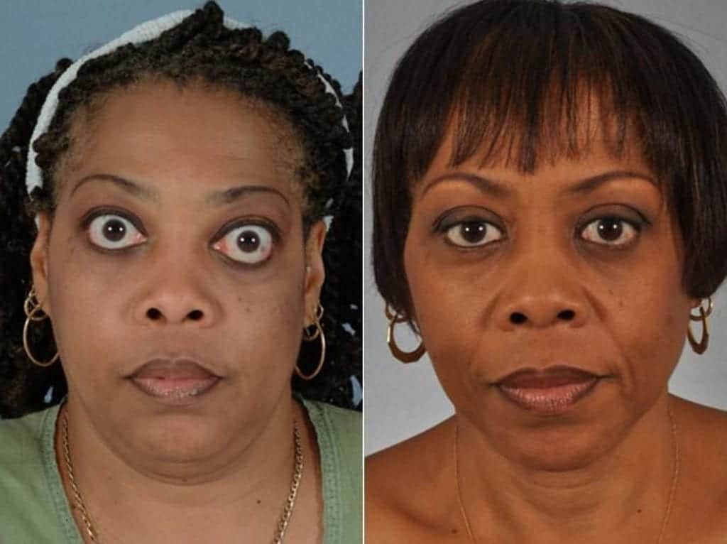 Thyroid Eye Disease Before & After Photos | W Cosmetic Surgery