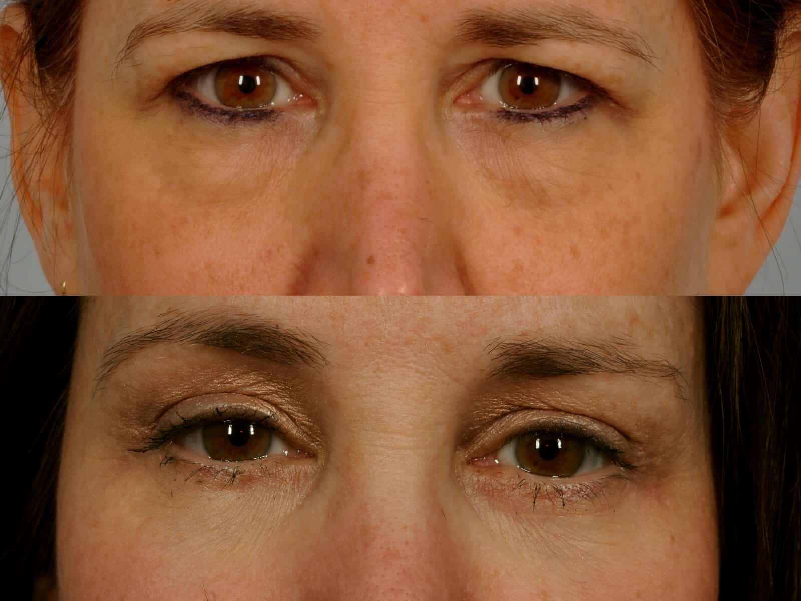 Brow Lift Before & After Photos | W Cosmetic Surgery