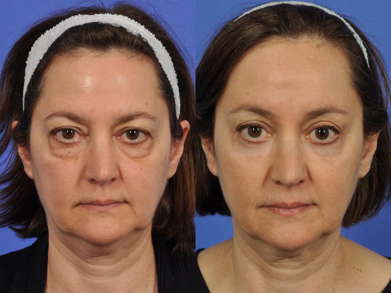 Brow Lift Before & After Photos | W Cosmetic Surgery