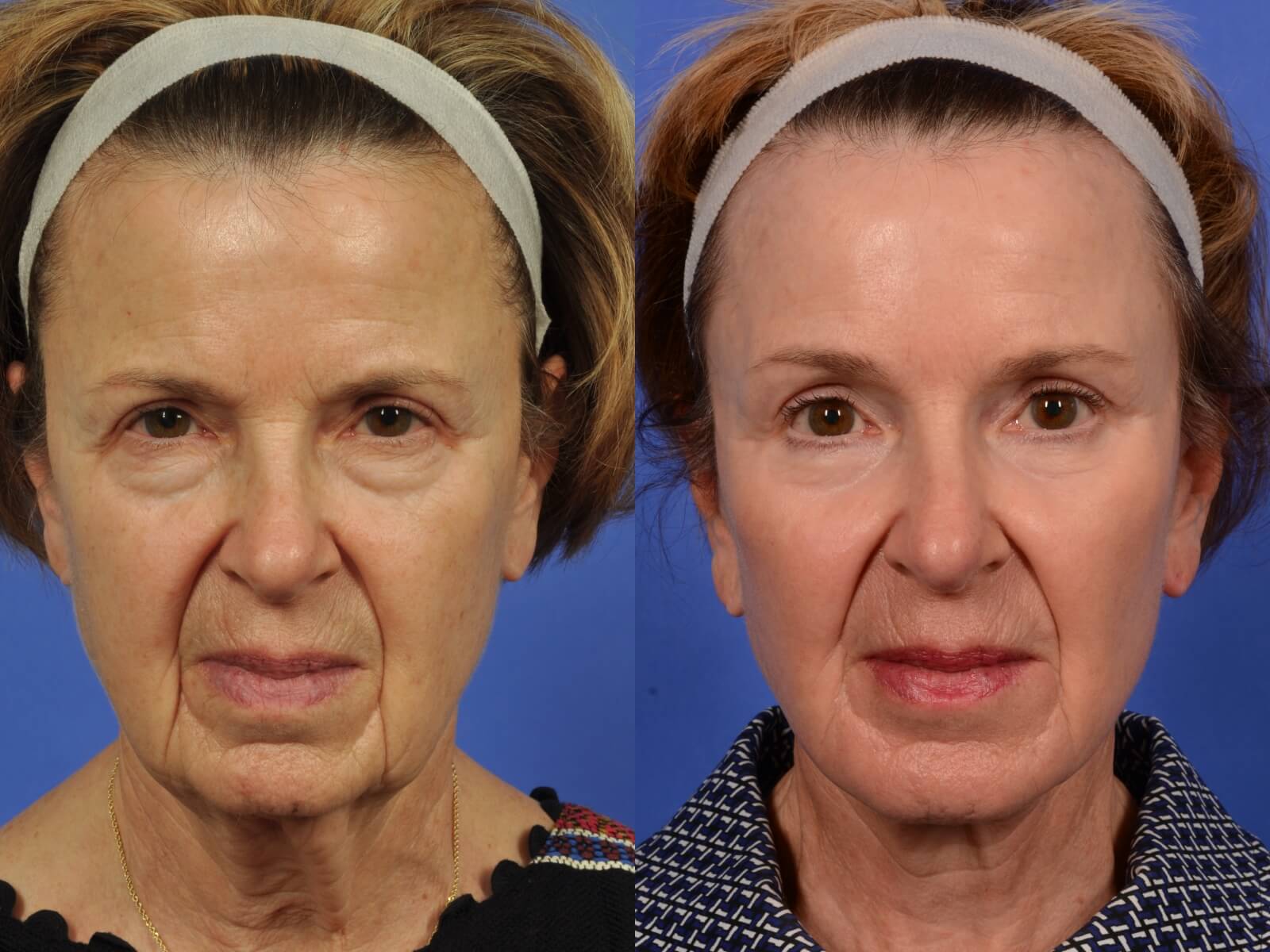 Brow Lift Before & After Photos | W Cosmetic Surgery