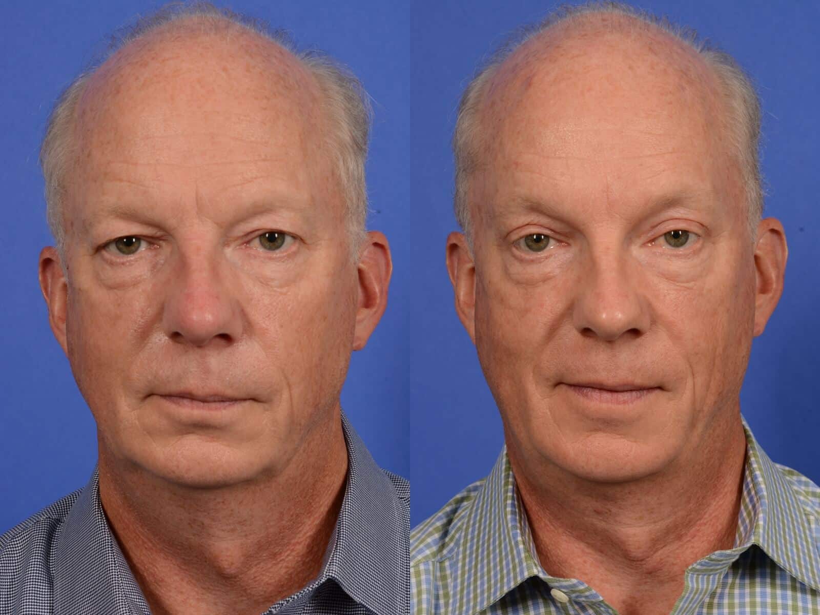 Brow Lift Before & After Photos | W Cosmetic Surgery