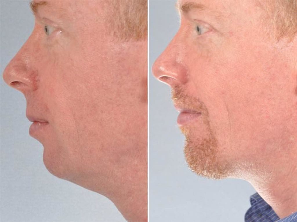 Chin Implant Before & After Photos | W Cosmetic Surgery