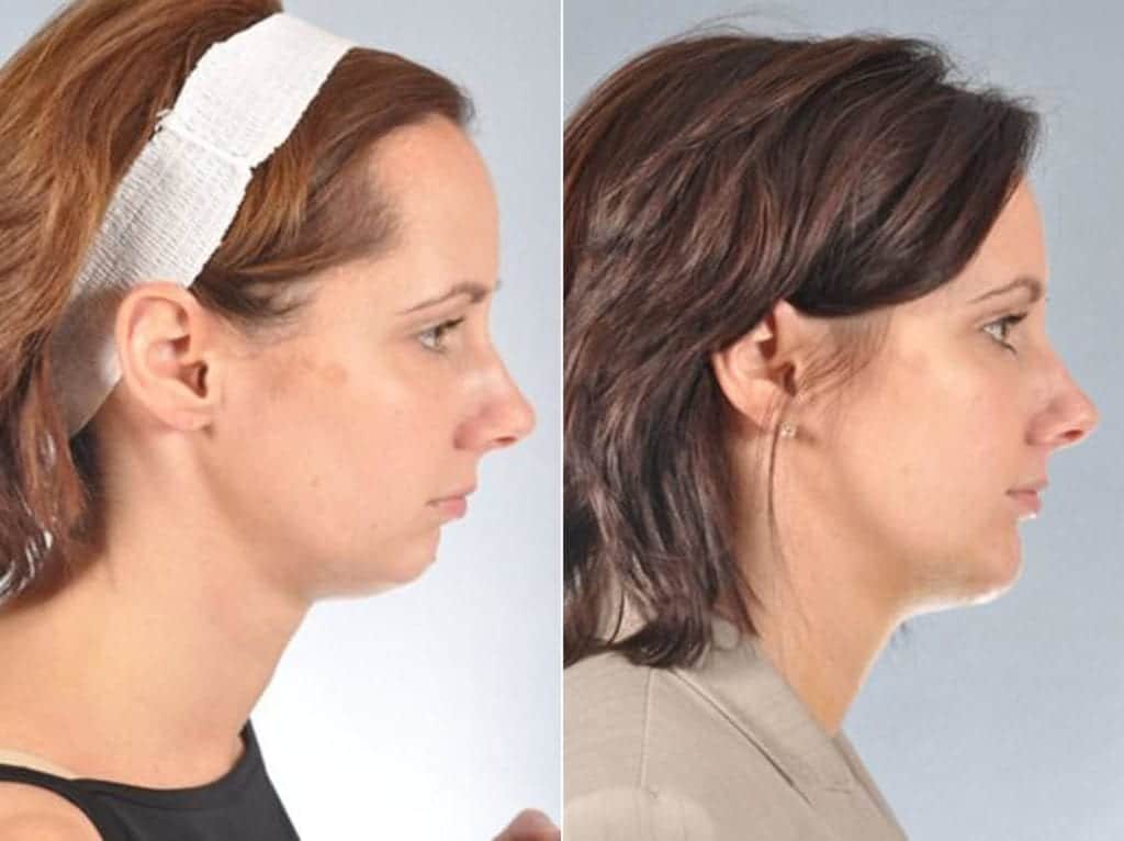 Chin Implant Before & After Photos | W Cosmetic Surgery