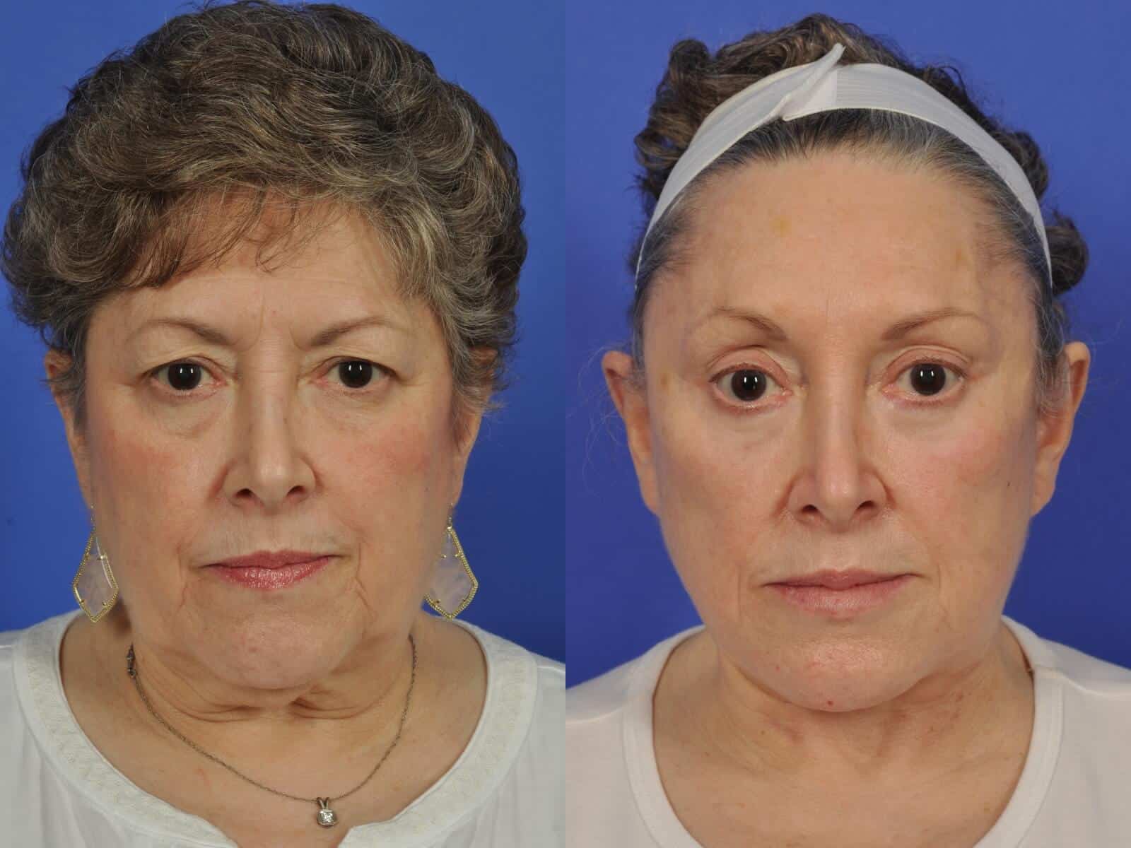 Facelift Before & After Photos | W Cosmetic Surgery