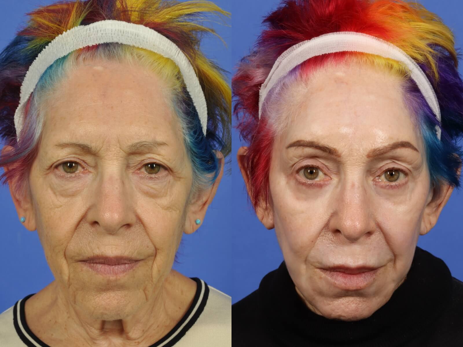 Laser Skin Resurfacing Before & After Photos | W Cosmetic Surgery