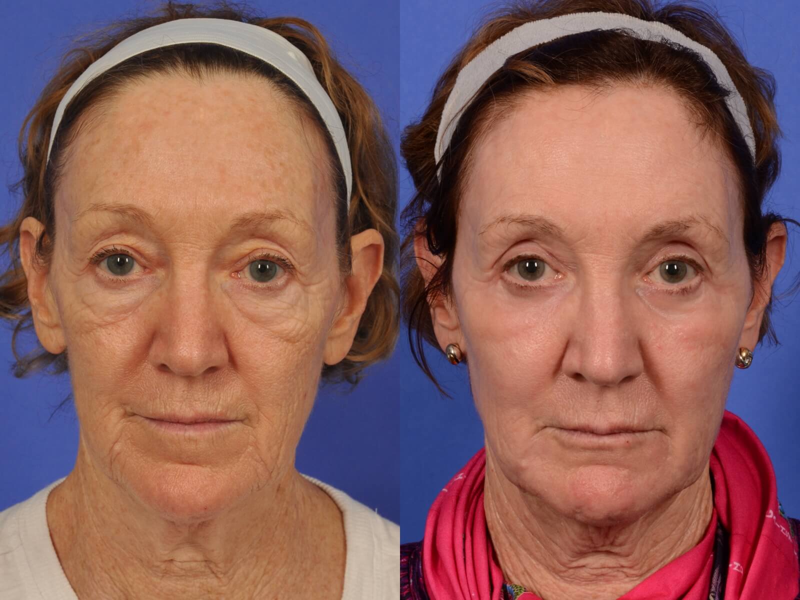 Laser Skin Resurfacing Before & After Photos | W Cosmetic Surgery