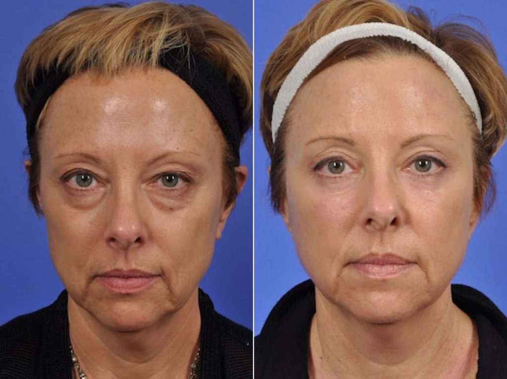 Laser Skin Resurfacing Before & After Photos | W Cosmetic Surgery