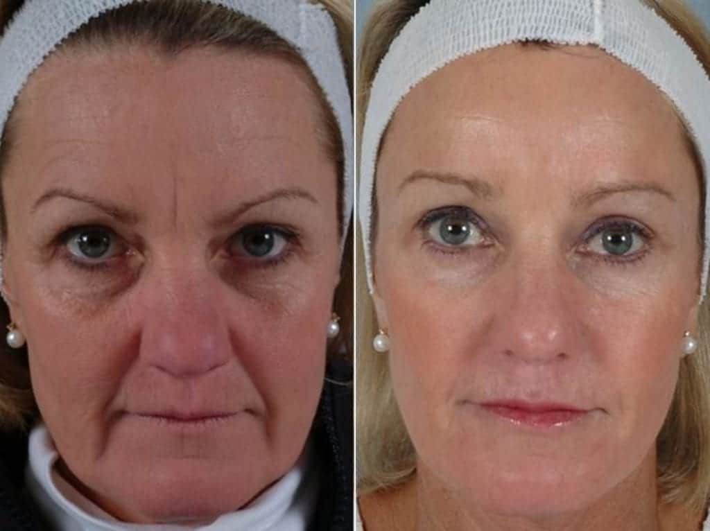 Laser Skin Resurfacing Before & After Photos | Page 2 | W Cosmetic Surgery