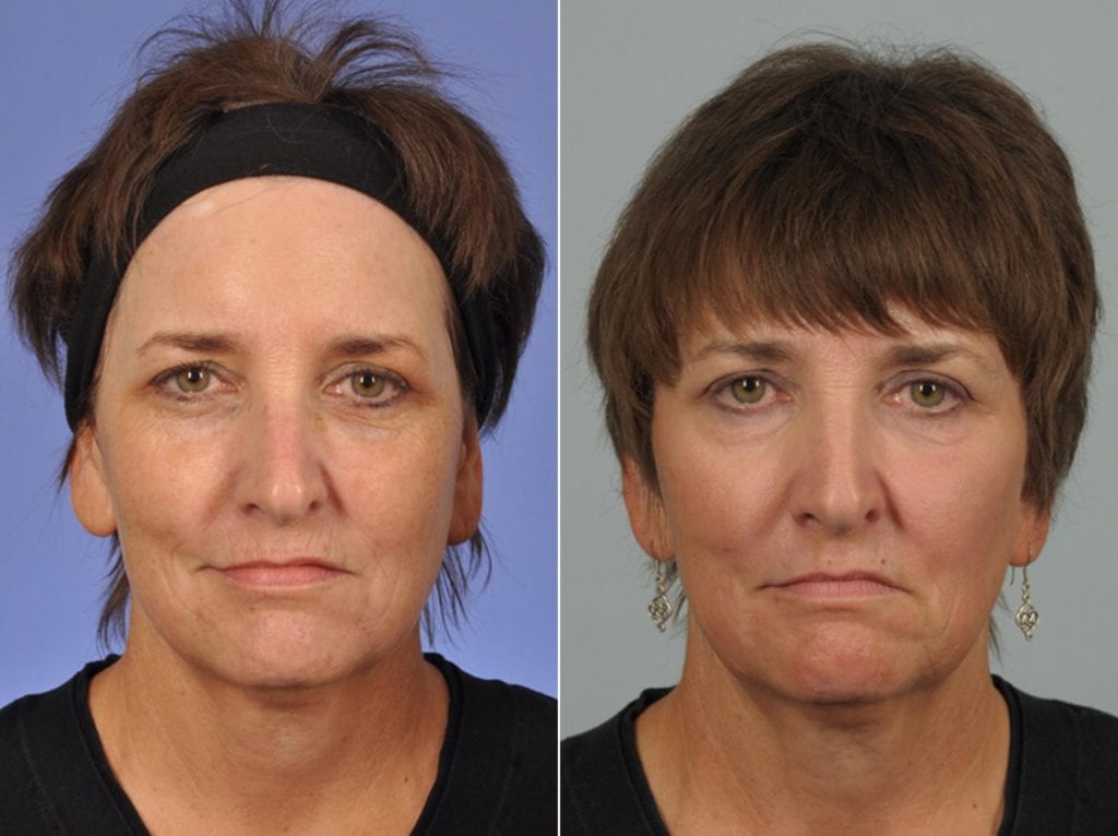 Laser Skin Resurfacing Before & After Photos | W Cosmetic Surgery
