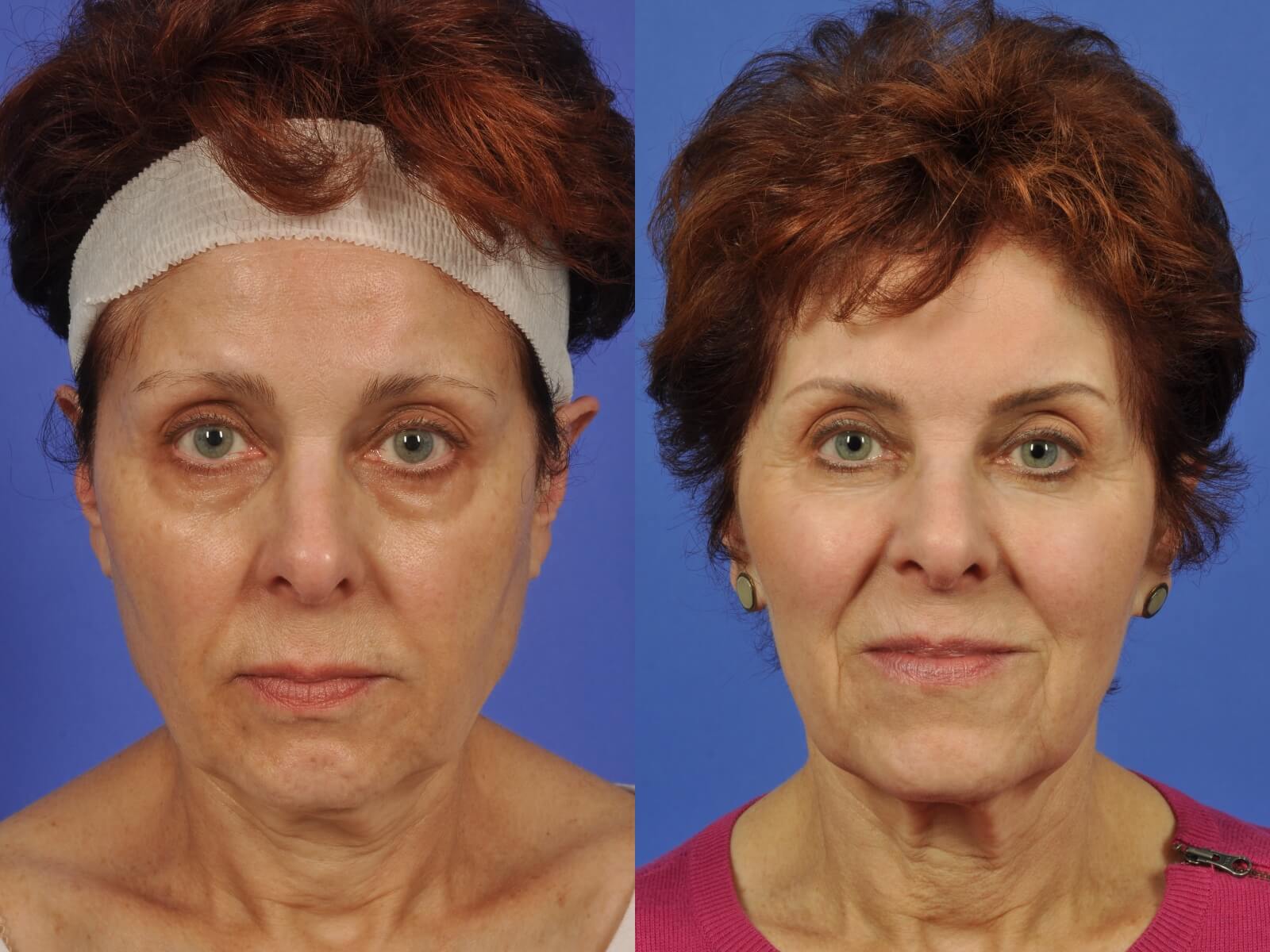 Laser Skin Resurfacing Before & After Photos | Page 3 | W Cosmetic Surgery