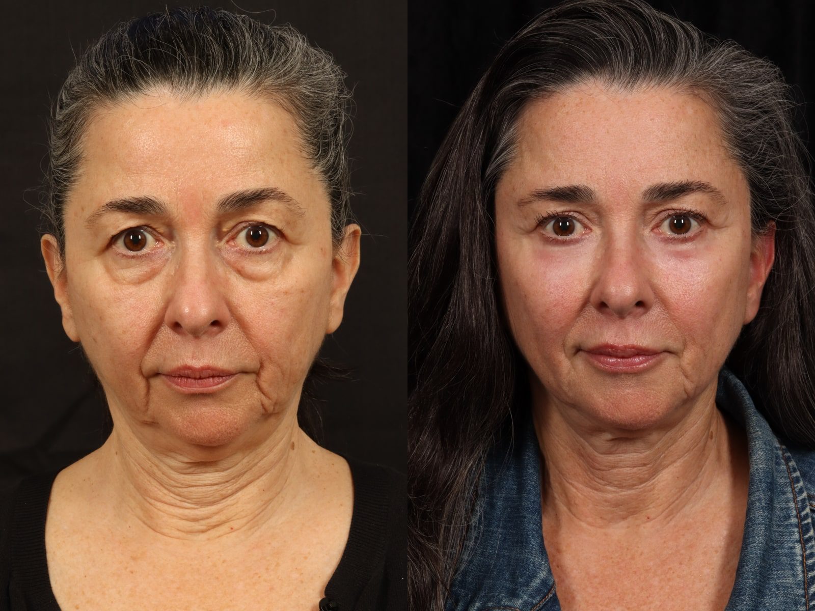 Mid Facelift Before & After Photos | W Cosmetic Surgery