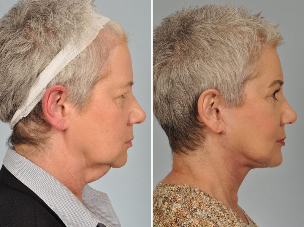 Mid Facelift Before & After Photos | W Cosmetic Surgery