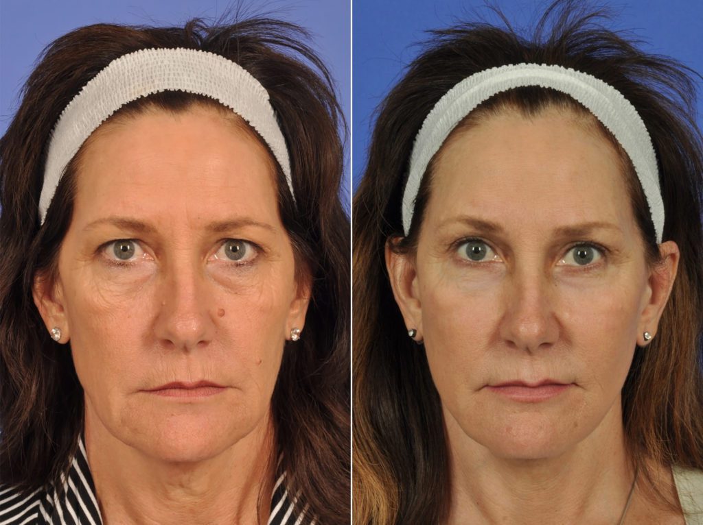 Mid Facelift Before & After Photos | W Cosmetic Surgery