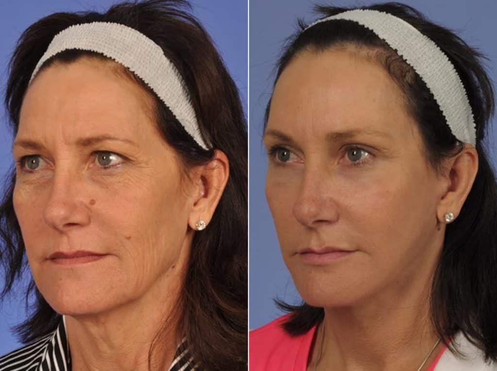 Mid Facelift Before & After Photos | W Cosmetic Surgery