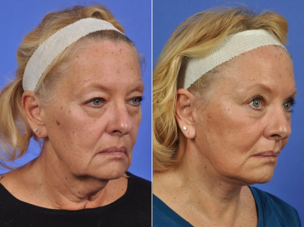 Mid Facelift Before & After Photos | W Cosmetic Surgery