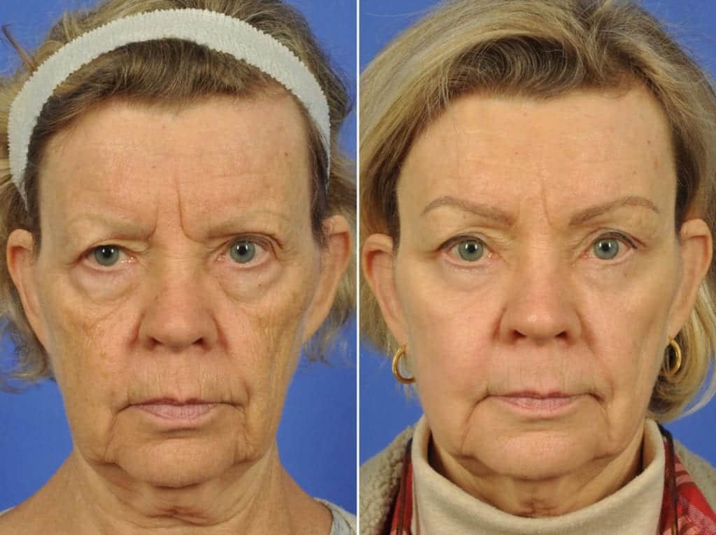 Mid Facelift Before & After Photos | W Cosmetic Surgery