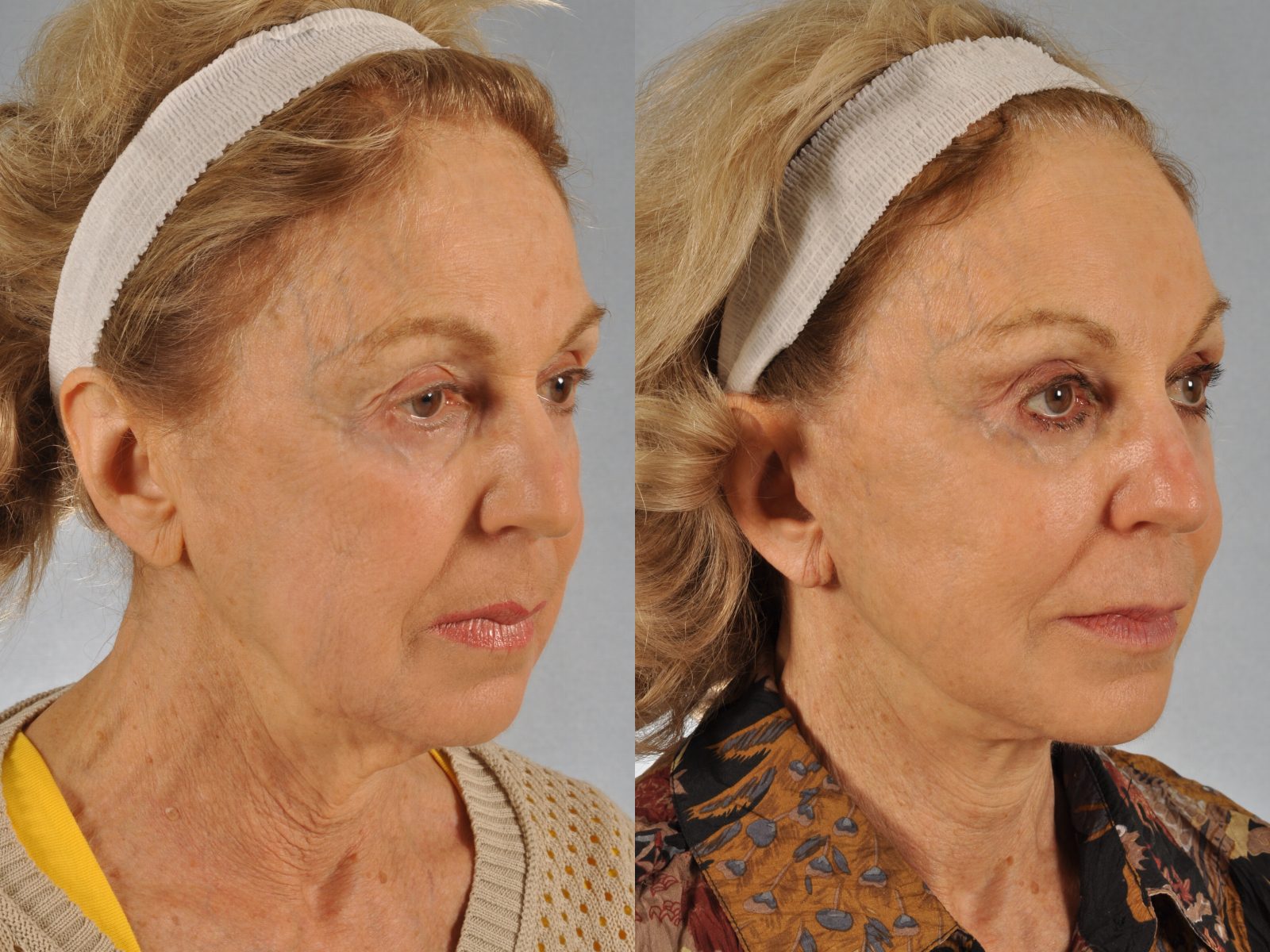 Mid Facelift Before & After Photos | W Cosmetic Surgery