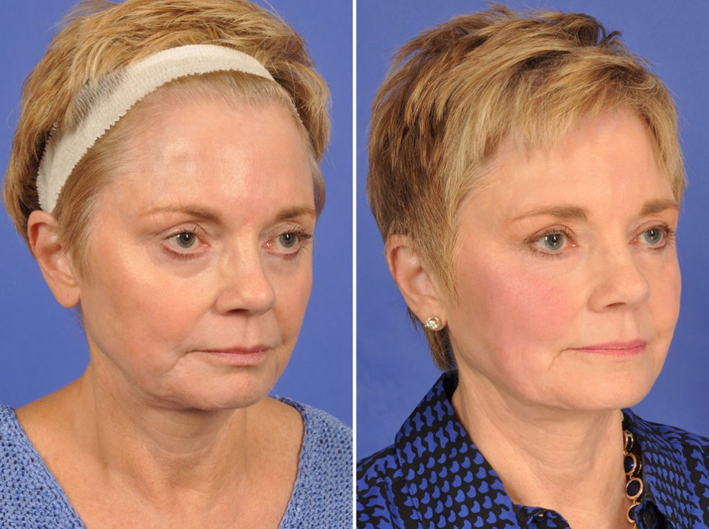 Mid Facelift Before & After Photos | W Cosmetic Surgery
