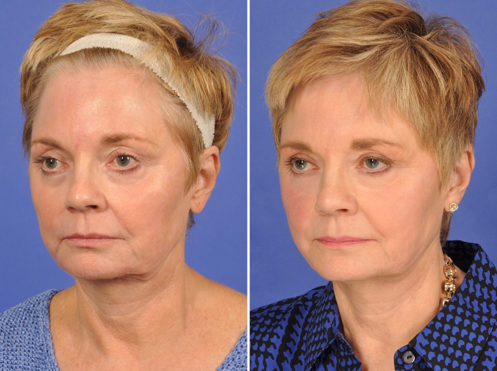 Mid Facelift Before & After Photos | W Cosmetic Surgery